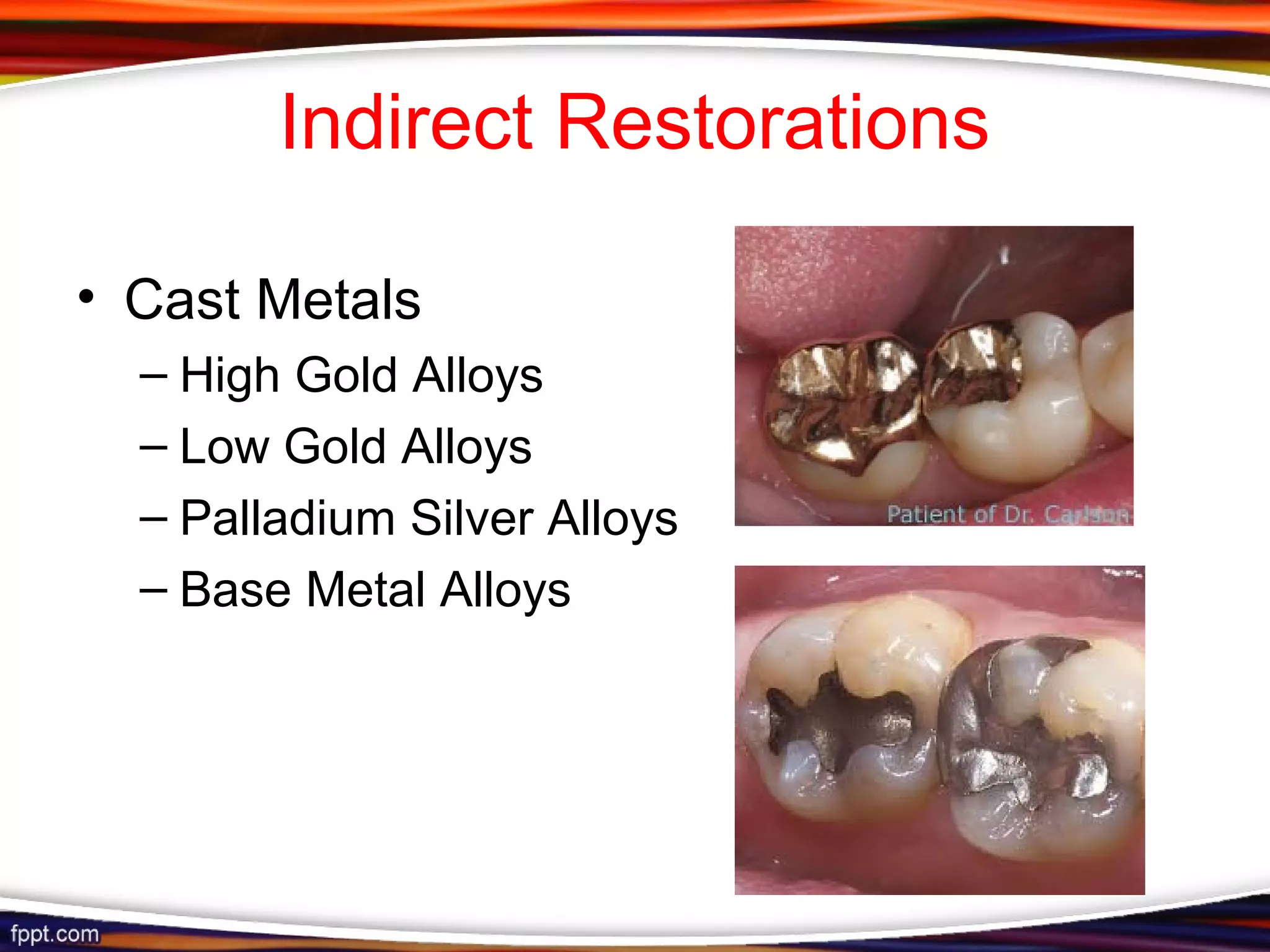 Inlays and onlays | PPT