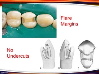 Inlays and onlays | PPT