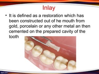 Inlays and onlays | PPT | Dental Health | Diseases and Conditions