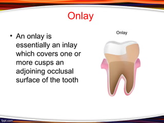 Inlays and onlays | PPT