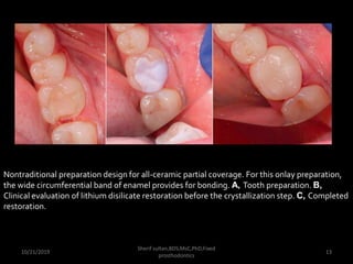 ceramic Inlays and onlays | PPTX