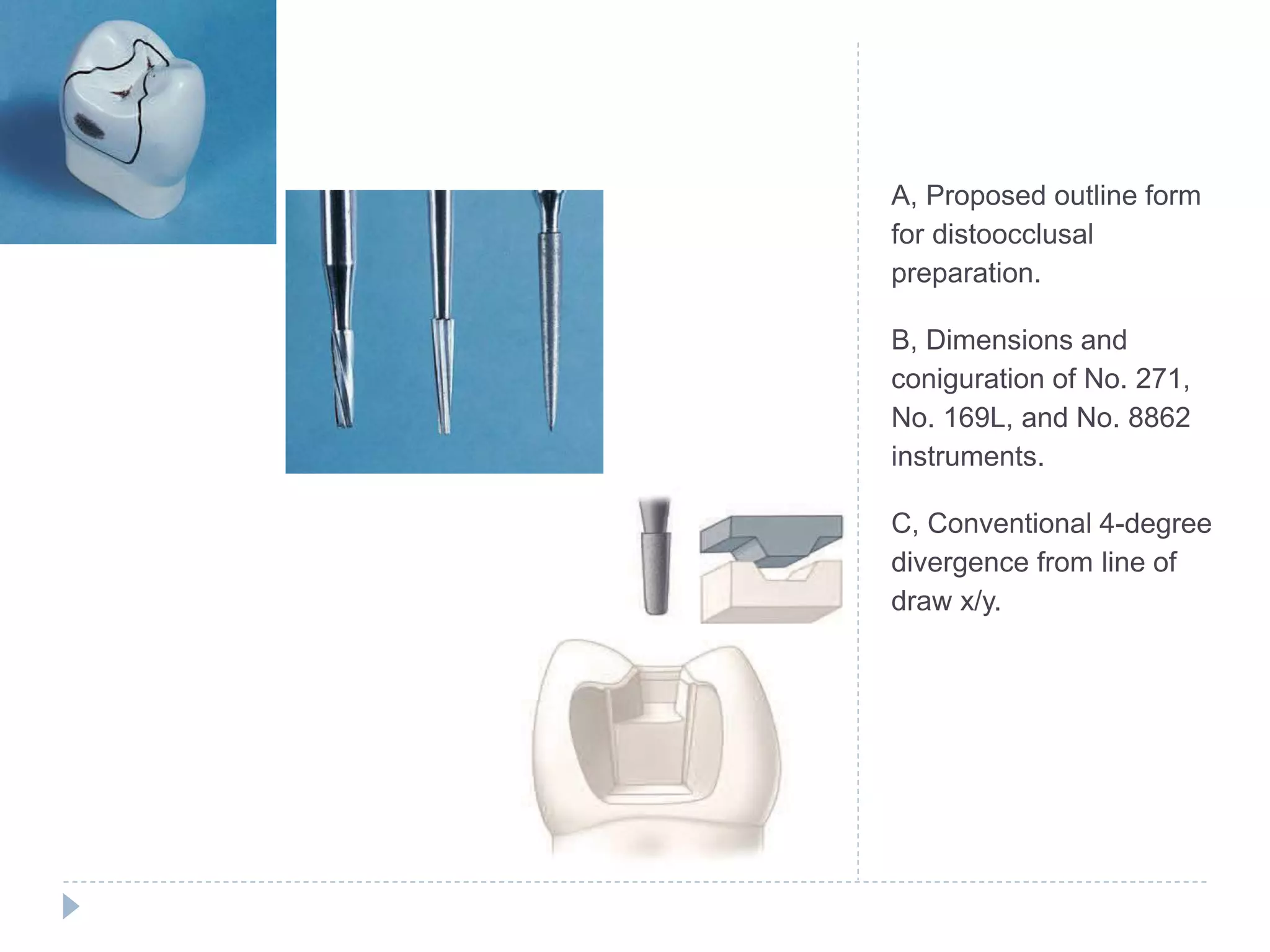 inlays and onlays.ppt