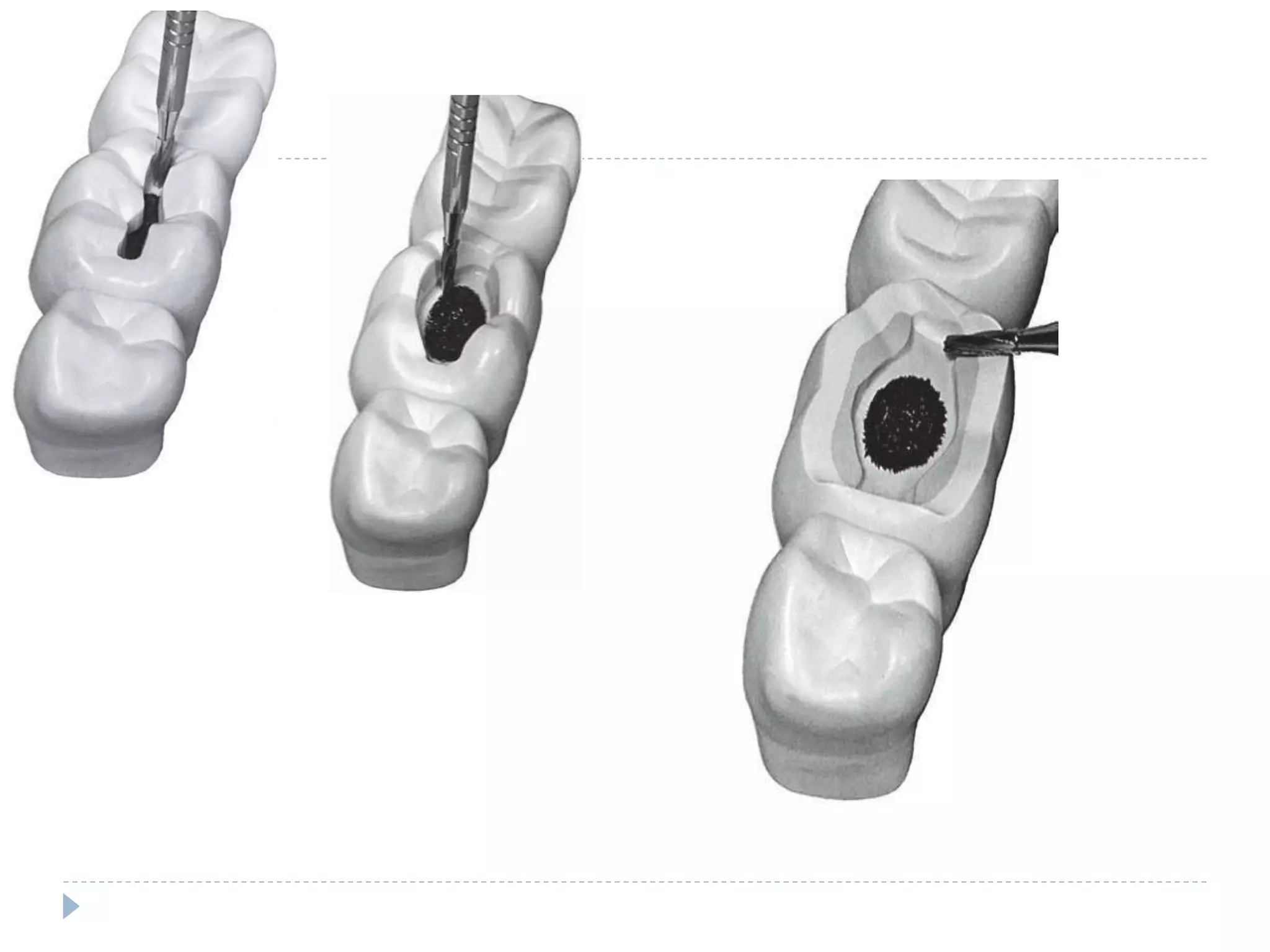 inlays and onlays.ppt
