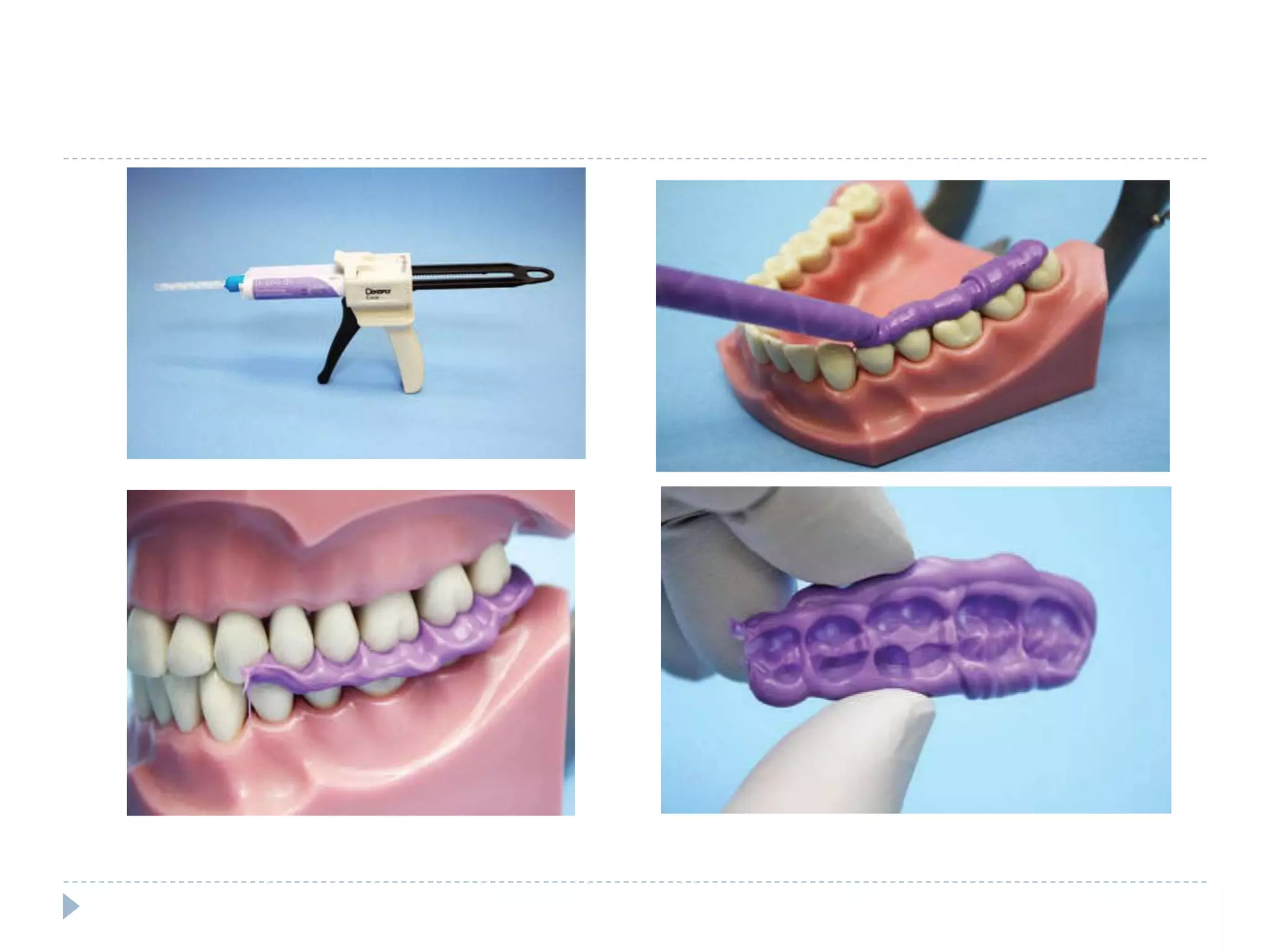 inlays and onlays.ppt