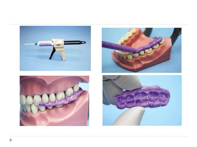 inlays and onlays.ppt | Dental Health | Diseases and Conditions