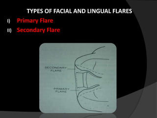 inlays and onlays, classification of inlays and onlays | PPTX