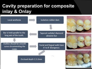 inlays and onlays, classification of inlays and onlays | PPTX
