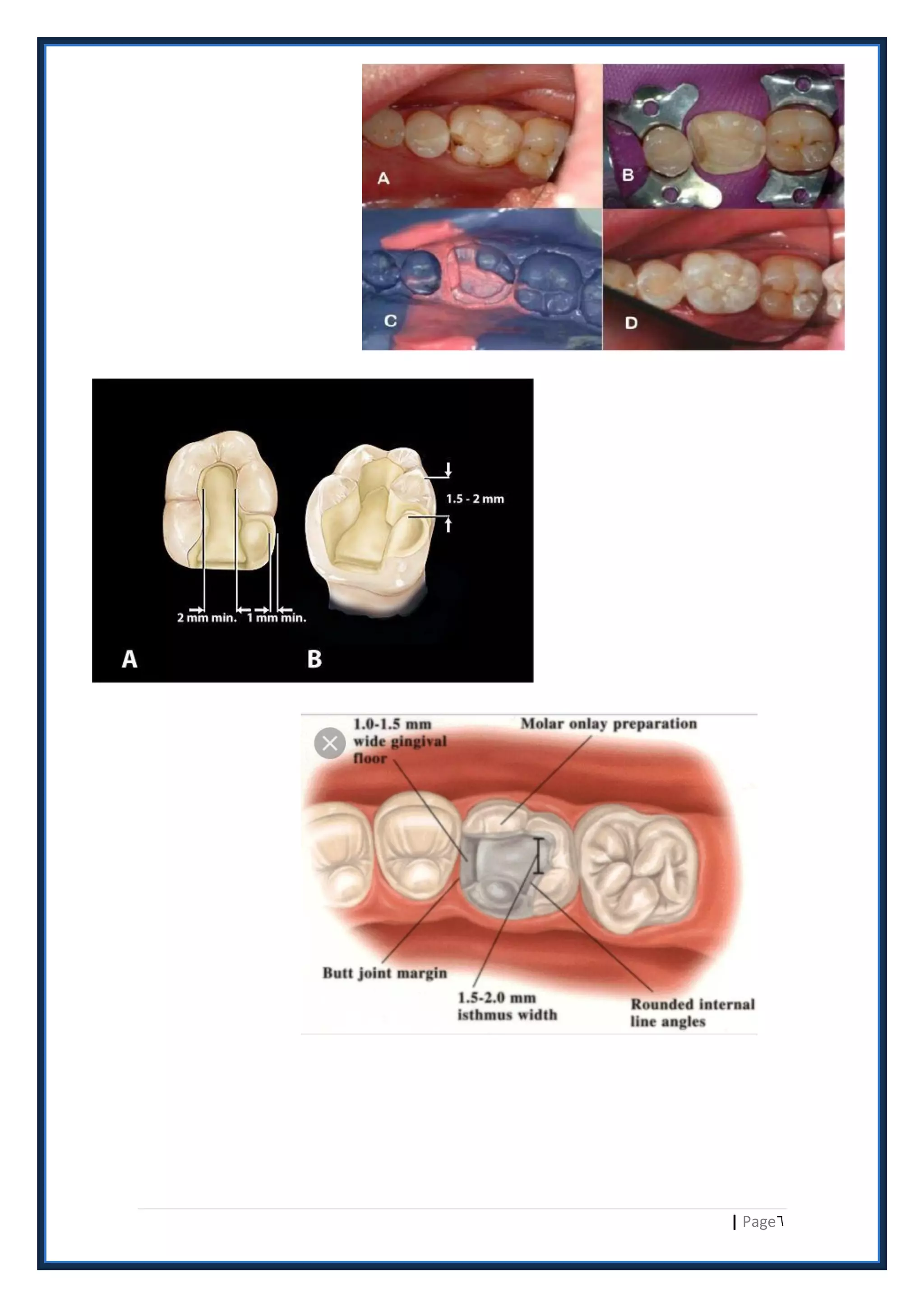 Inlays & onlays (crown and bridge ) | PDF | Dental Health | Diseases ...