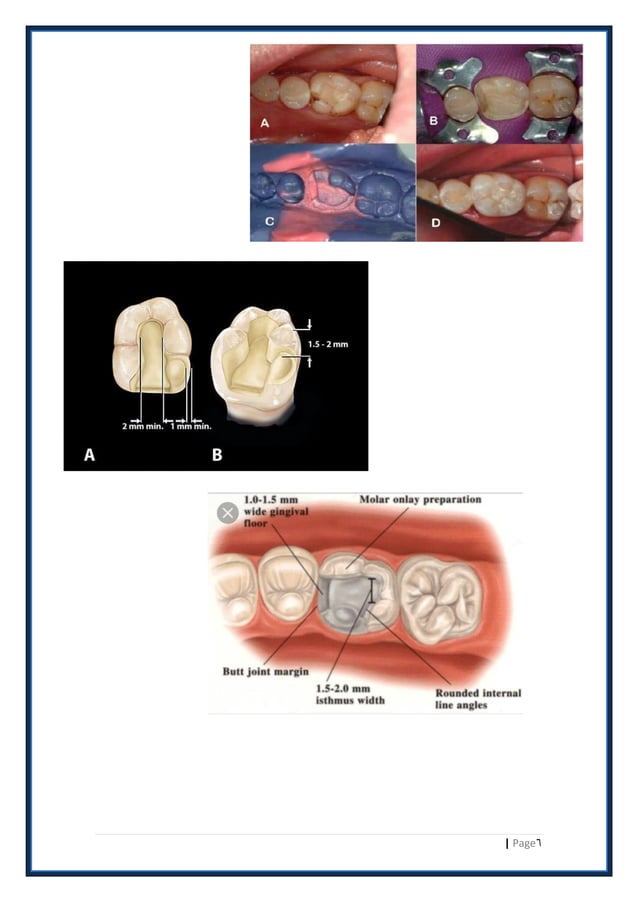 Inlays & onlays (crown and bridge ) | PDF | Dental Health | Diseases ...