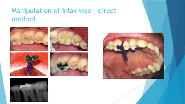 Inlay wax USED IN OPERATIVE DENTISTRY.pptx