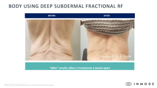 InMode-INMD-Profile-Q12022.ppmt.ppsx