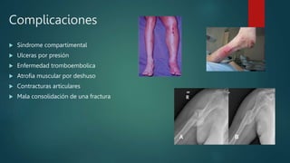 Inmovilizaciones de extremidades superior e inferior | PPTX
