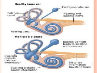 Inner ear Disorder : Nursing care | PPTX