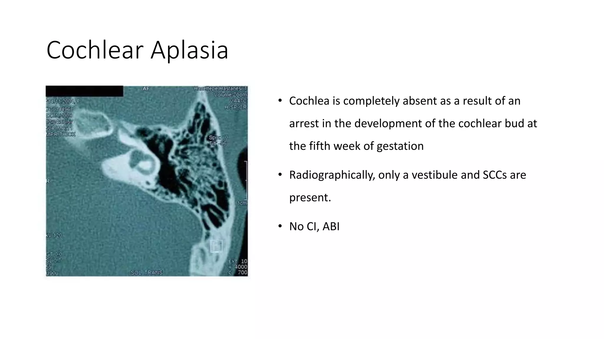 Inner ear malformations and Implantation | PPTX