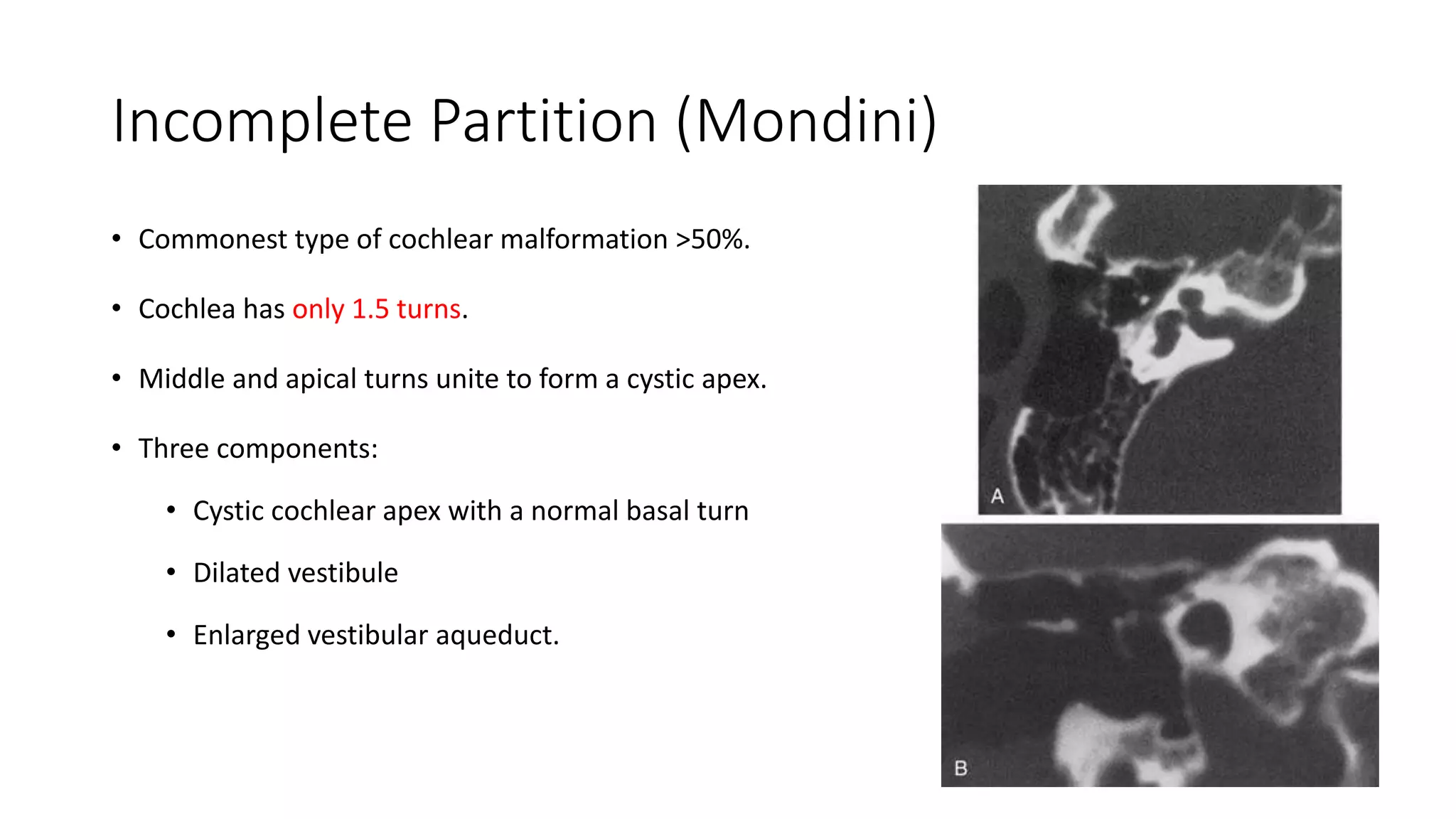 Inner ear malformations and Implantation | PPTX