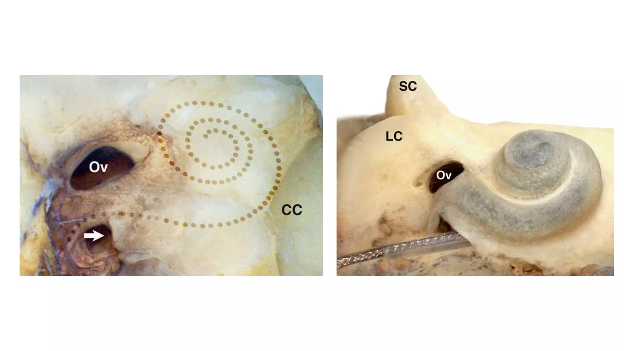 Inner ear malformations and Implantation | PPTX