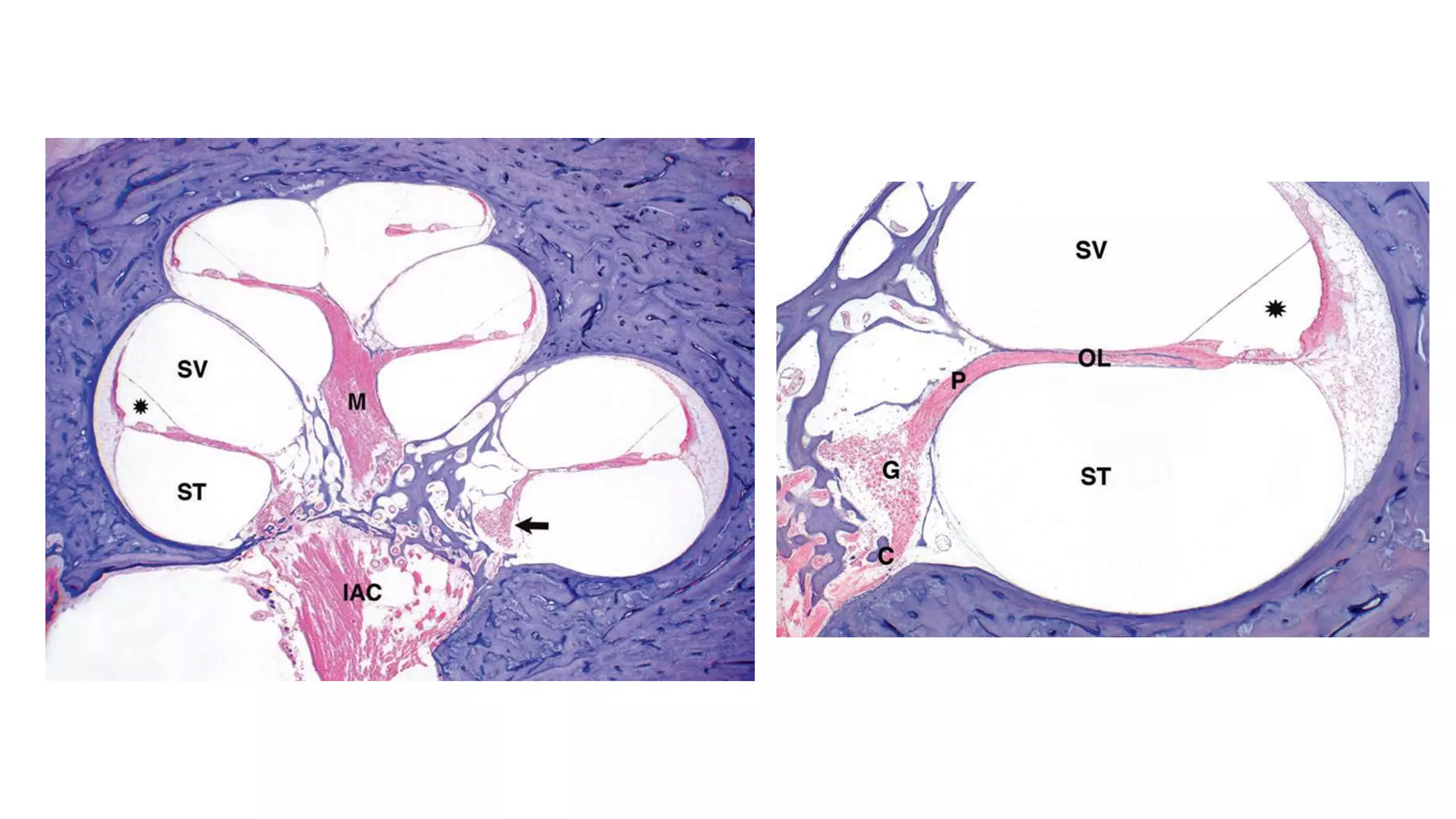 Inner ear malformations and Implantation | PPTX