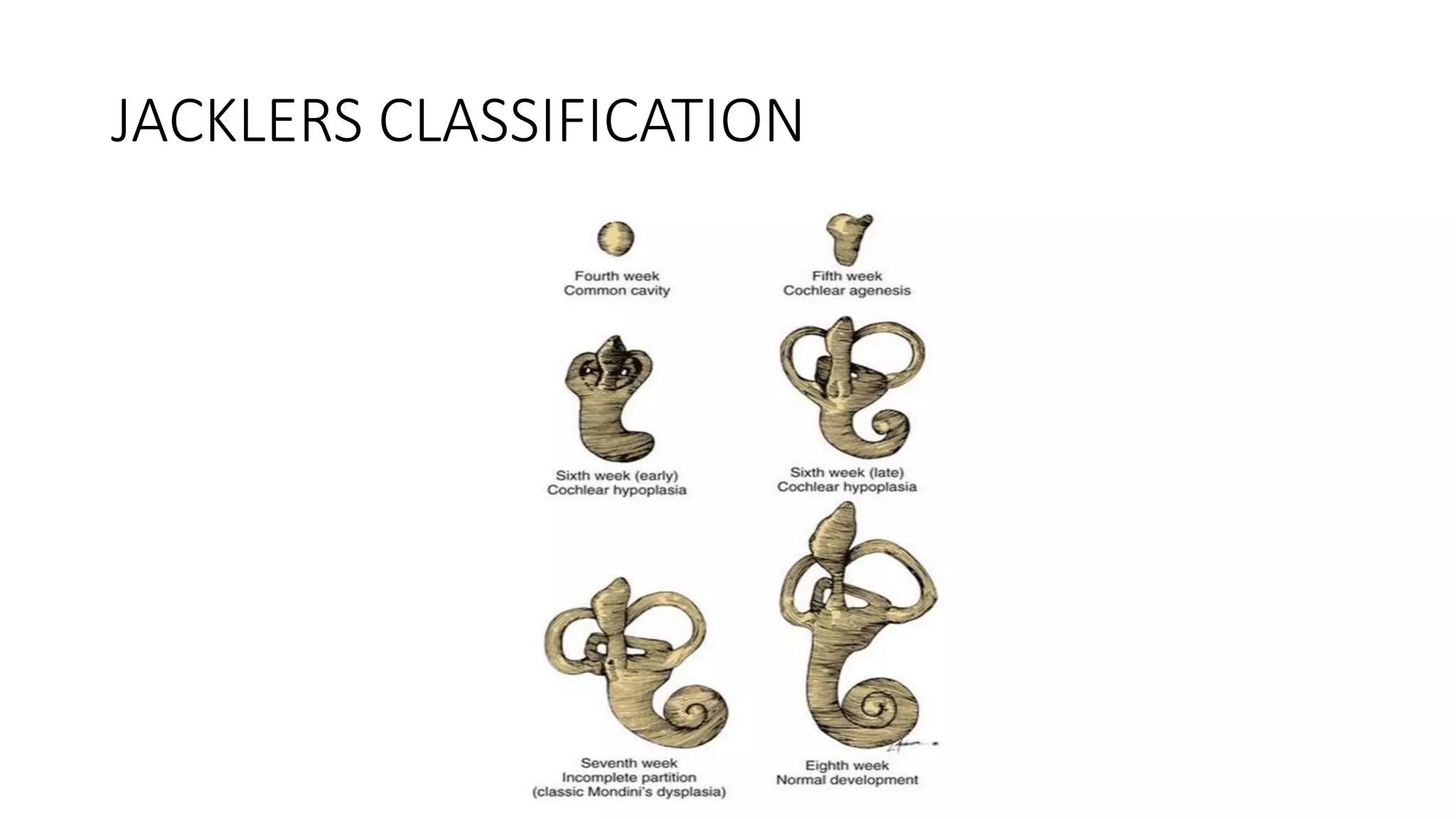Inner ear malformations and Implantation | PPTX