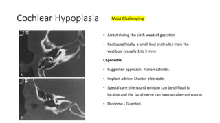 Inner ear malformations and Implantation | PPTX