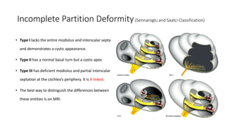 Inner ear malformations and Implantation | PPTX