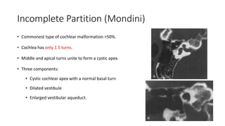 Inner ear malformations and Implantation | PPTX