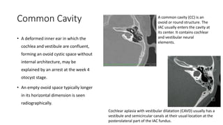 Inner ear malformations and Implantation | PPTX