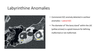 Inner ear malformations and Implantation | PPTX