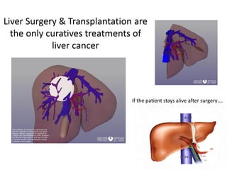 Innovation in Liver Surgery | PDF