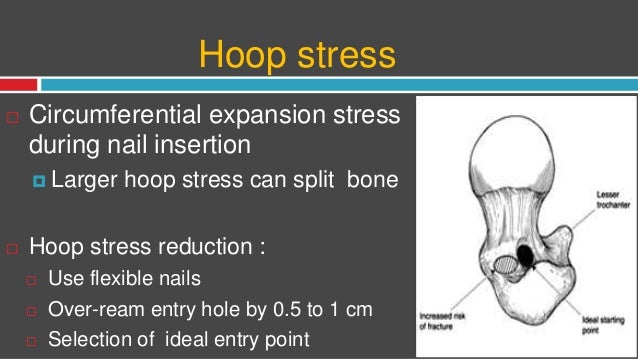 Inra medullary nailing - basic concepts