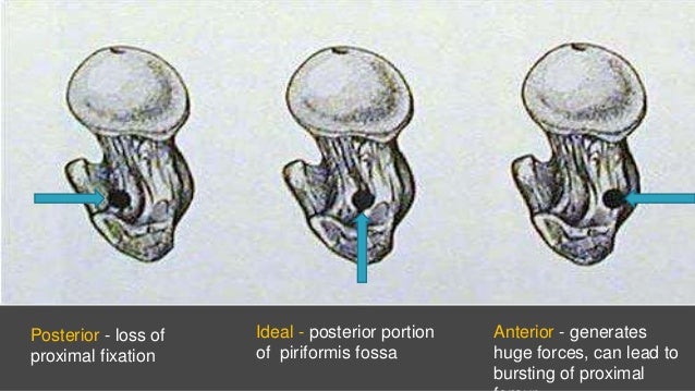 Inra medullary nailing - basic concepts