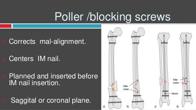 Inra medullary nailing - basic concepts