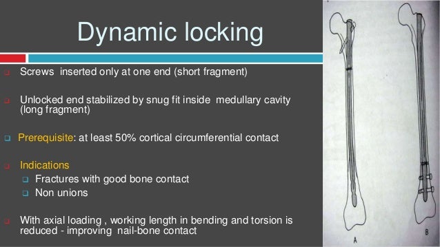 Inra medullary nailing - basic concepts