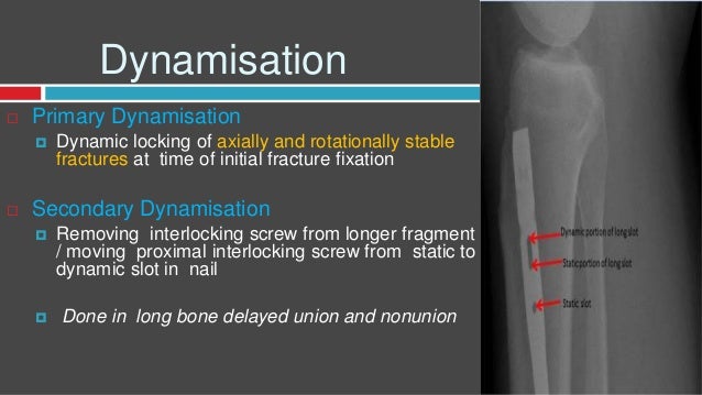 Inra medullary nailing - basic concepts