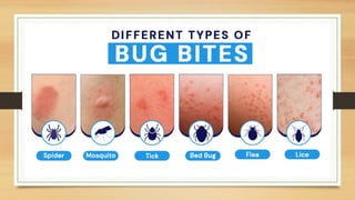 FIRST AID OF INSECTS BITE AND STING BITE | PPTX