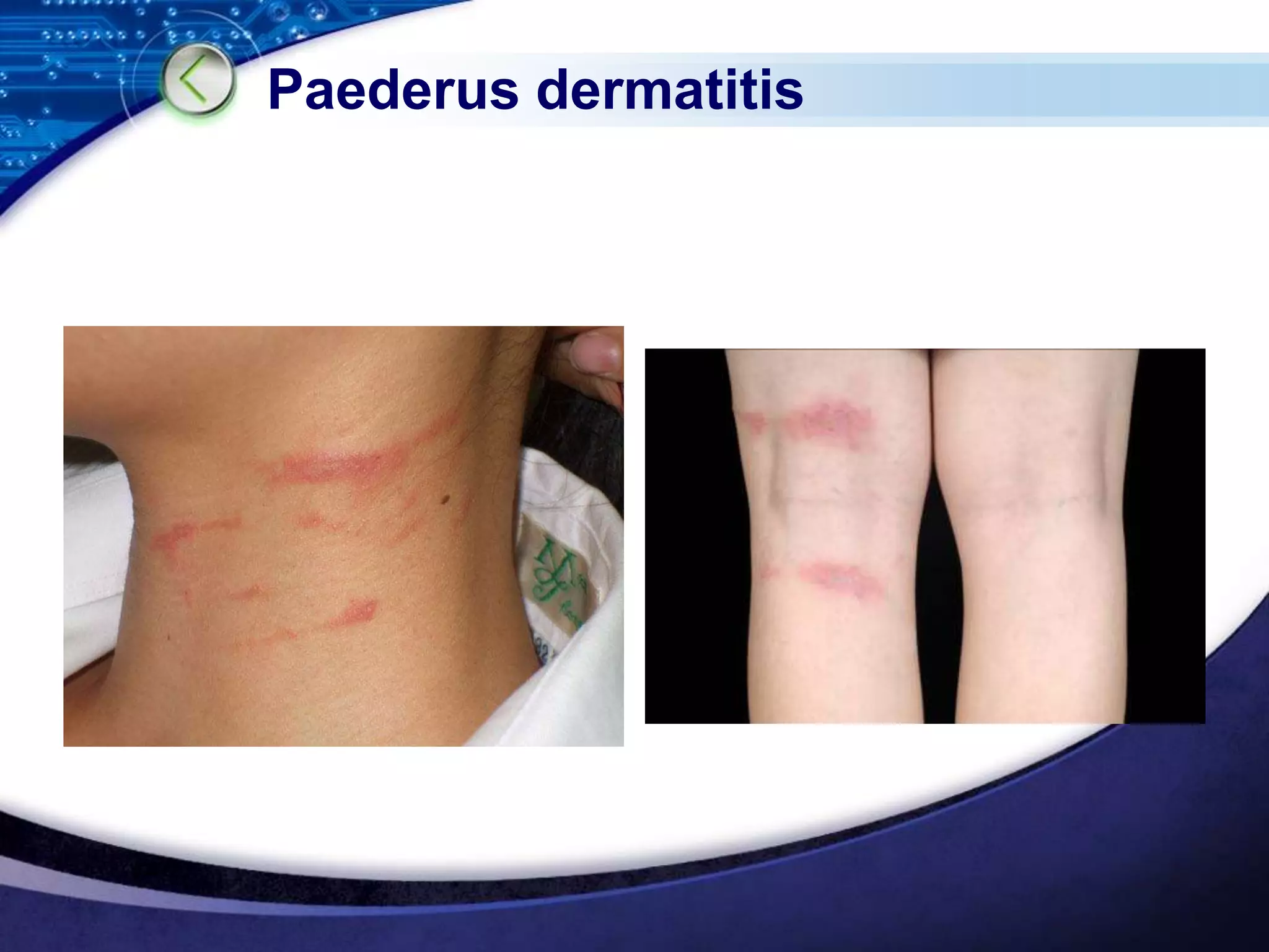 Insect bites and stings | PPTX