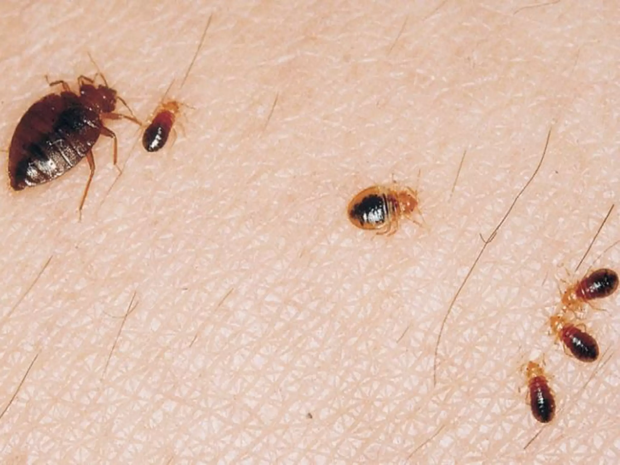 Insects Bites & Stings-Papular Urticaria | PDF