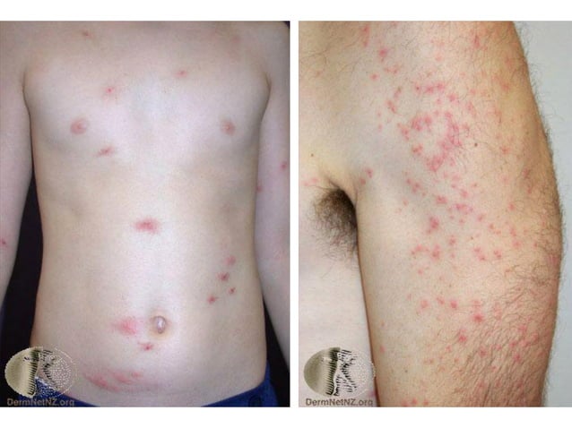 Insects Bites & Stings-Papular Urticaria | PPT