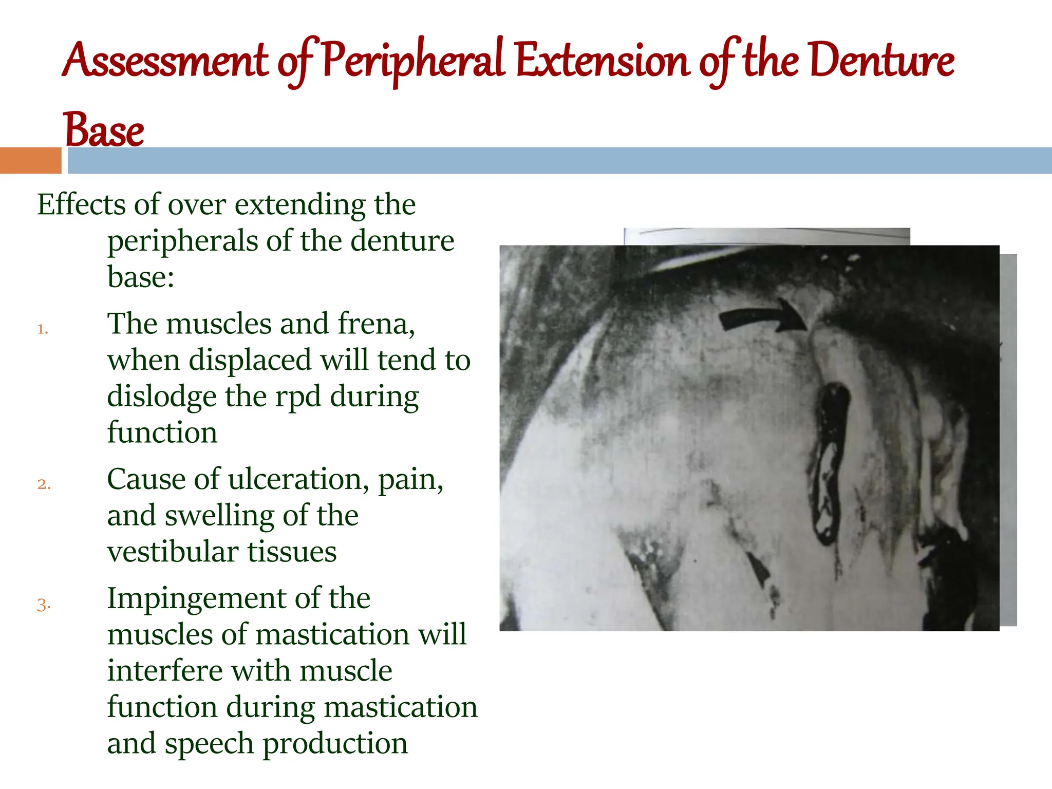 insertion-and-postinsertion-of-Removable partial denture | PPT