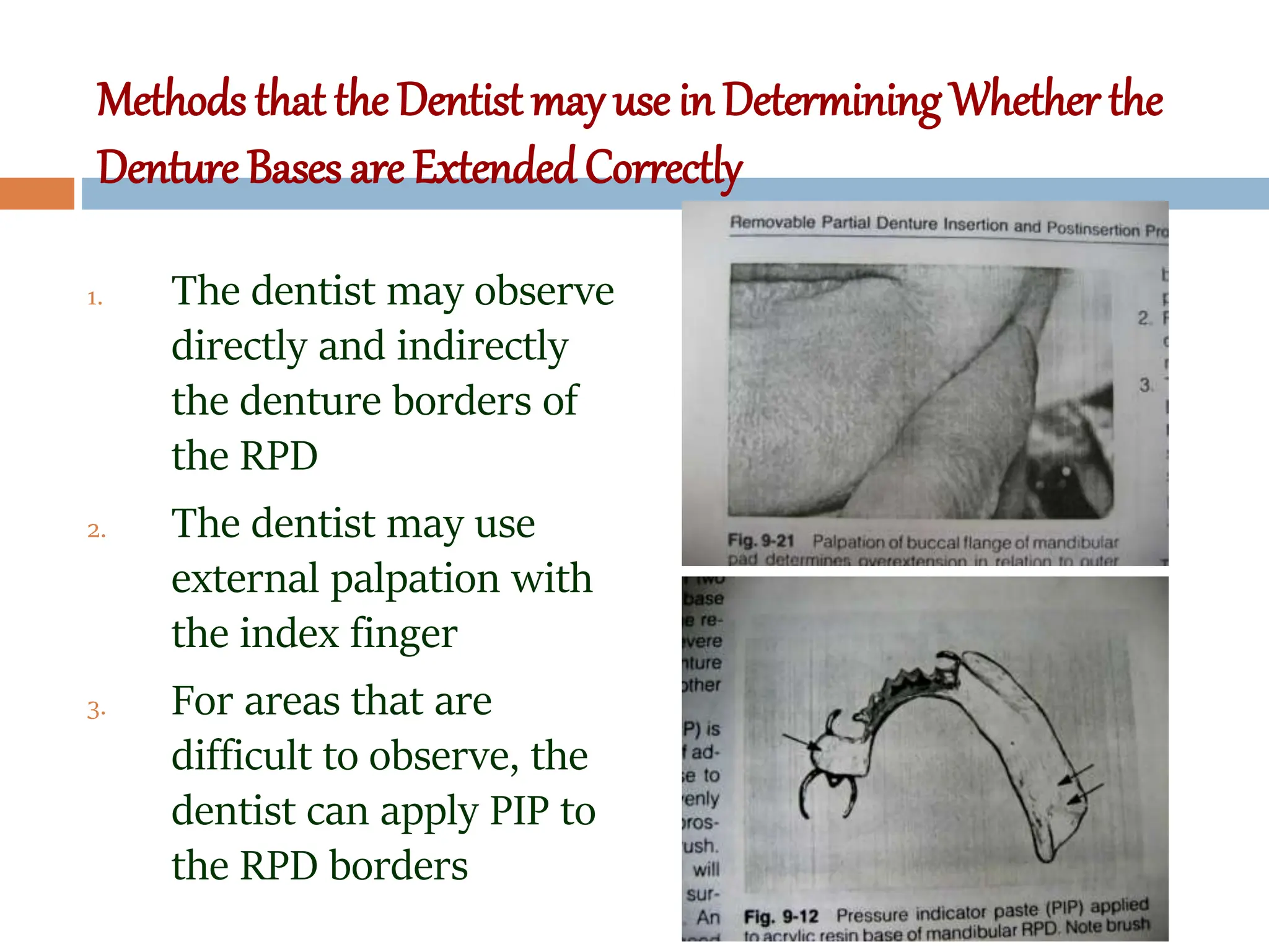 insertion-and-postinsertion-of-Removable partial denture | PPT