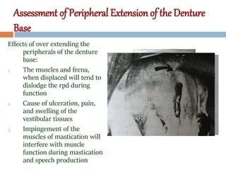 insertion-and-postinsertion-of-Removable partial denture | PPT