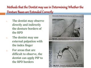 insertion-and-postinsertion-of-Removable partial denture | PPT