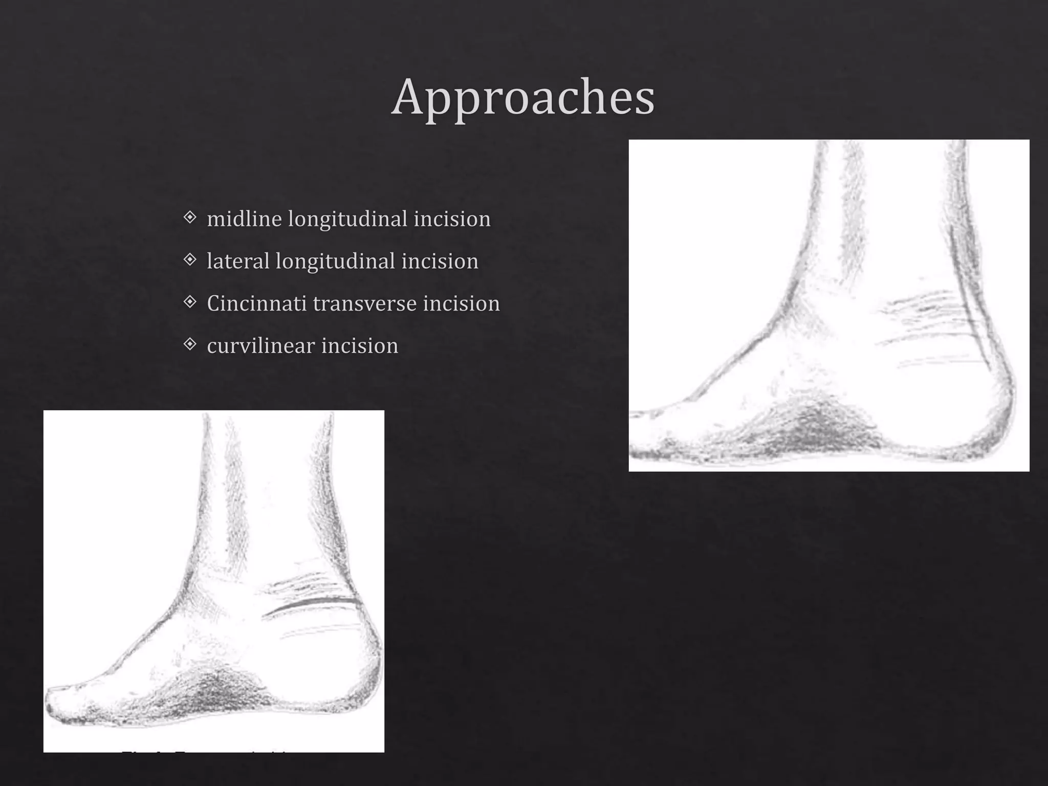 Insertional achilles tendinopathy shamseer | PPTX | Medical Health