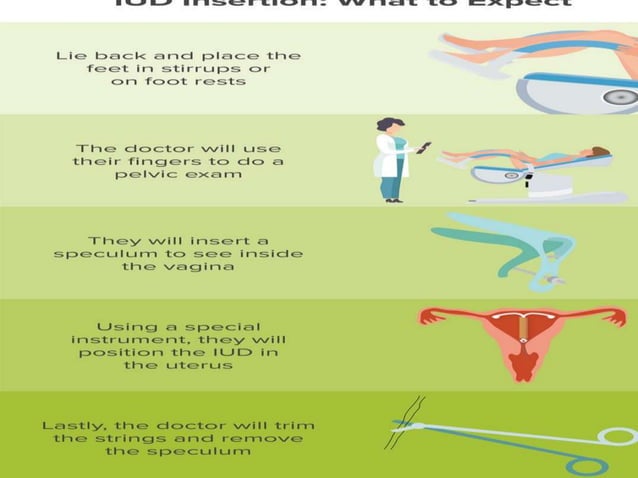 IUD (Intra Uterine Device) | PPTX