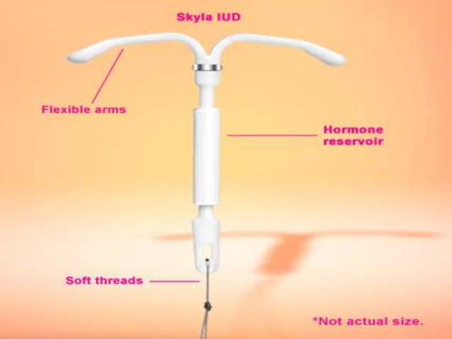 IUD (Intra Uterine Device) | PPTX