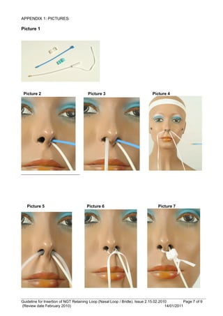 Insertion of ngt retaining device nasal loop bridle | DOC