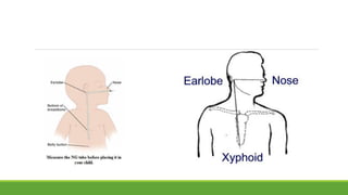 Insertion of NG tube | PPTX