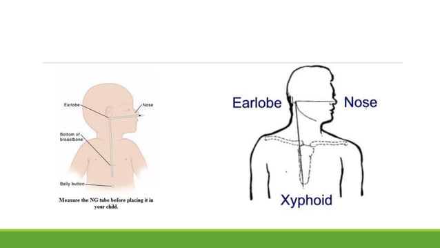 Insertion of NG tube | PPTX