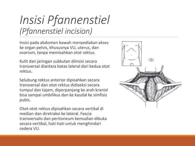 Insisi abdomen pada anak | PPTX