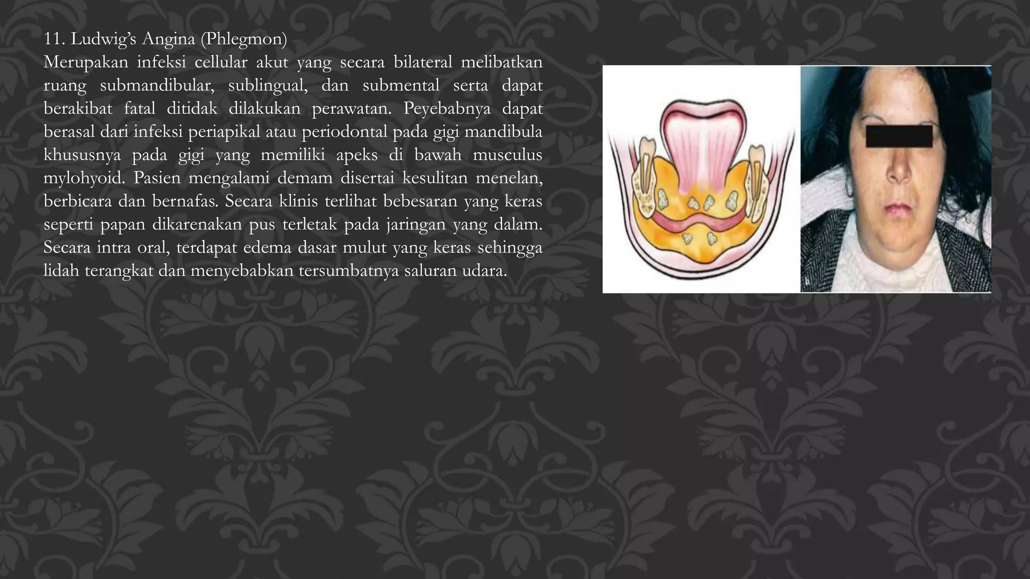 INSISI ABSES drg.Harijadi .pptx