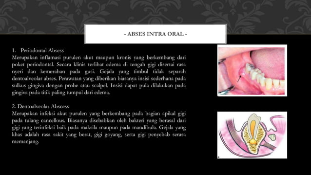 INSISI ABSES drg.Harijadi .pptx